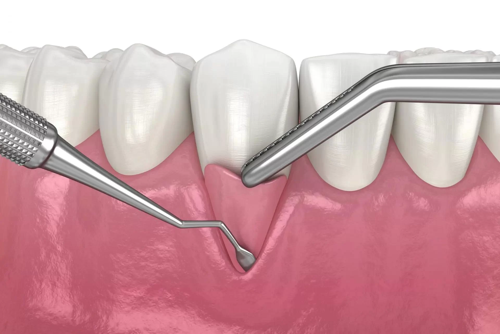 What is a Gingival Graft and When is It Needed? Understanding Gum Graft ...