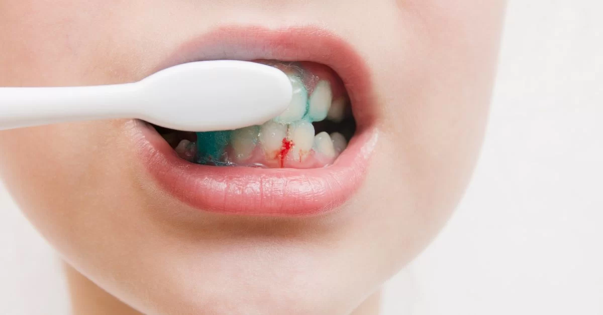 Why Do My Gums Bleed When I Brush My Teeth? Causes and Solutions