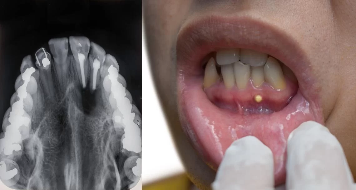 Symptoms of an Abscessed Tooth and How to Treat It: A Complete Guide